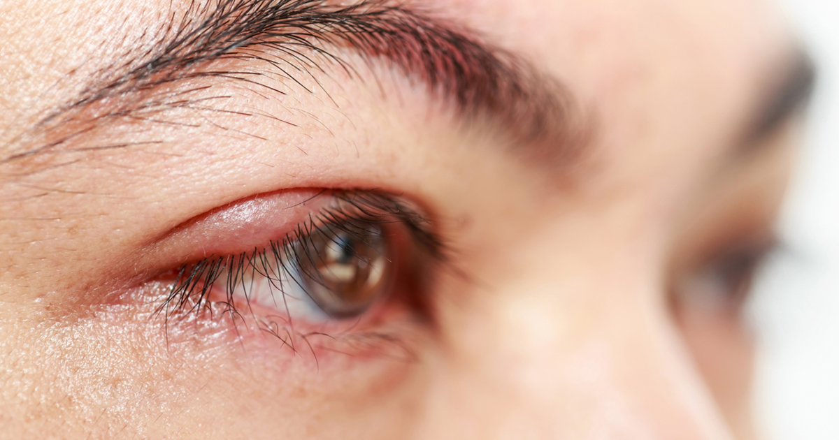 What Causes White Bump on Eyelid? Easy Tips and Treatment Advice What Causes White Bump on Eyelid? Easy Tips and Treatment Advice