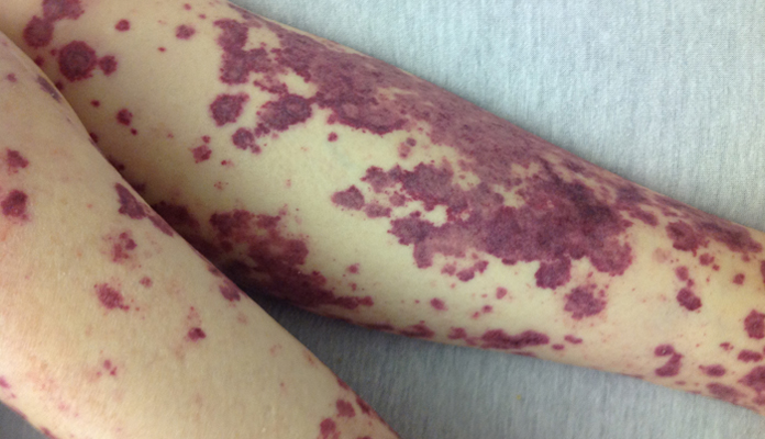 Learn About Bleeding Into The Skin – The Causes and The Cures